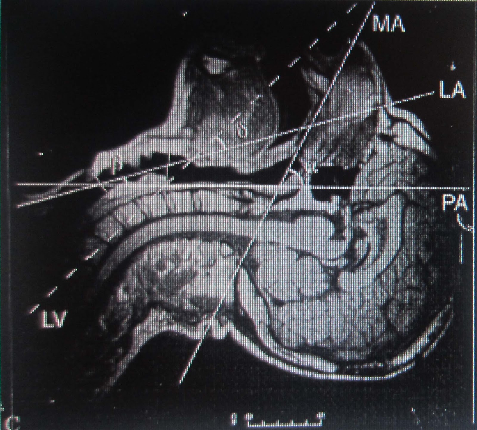 Glidescope Jack: Position Analysis for GlideScope Intubation