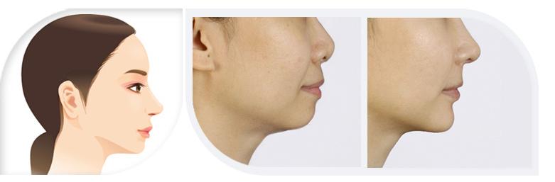 Eyelid Surgery Legend Dr. Kim Byung Gun: [BK Plastic Surgery Hospital ...