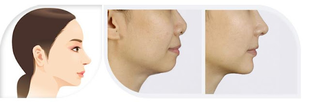 Eyelid Surgery Legend Dr. Kim Byung Gun: [BK Plastic Surgery Hospital ...