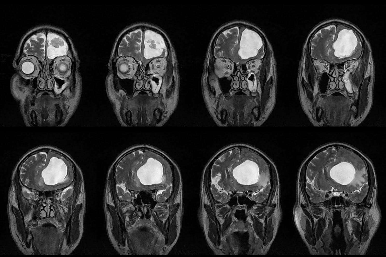 Dr Balaji Anvekar FRCR: Frontal SOL, Guess Histopathology