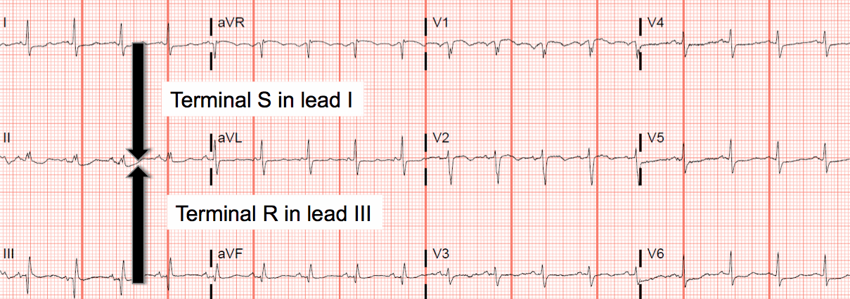 Two EKG patterns of pulmonary embolism which mimic MI