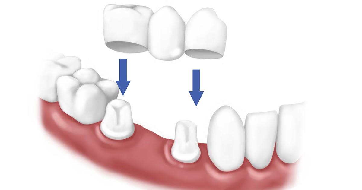 Removable Partial Denture: Crowns