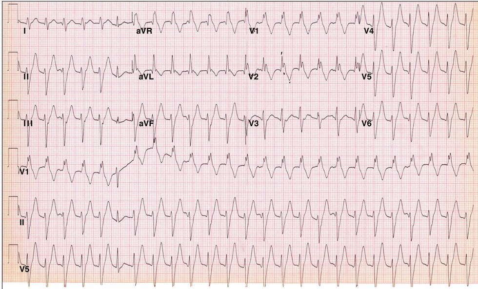 Fascicular Ventricular Tachycardia | INA - ECG