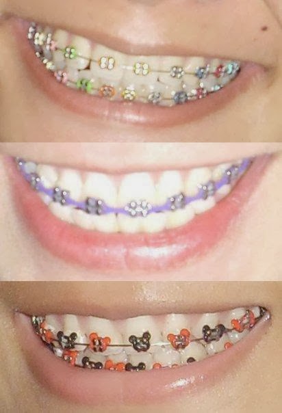 Spesialis Behel Gigi Bandung: Spesialis Gigi Behel Bandung Harga Terjangkau