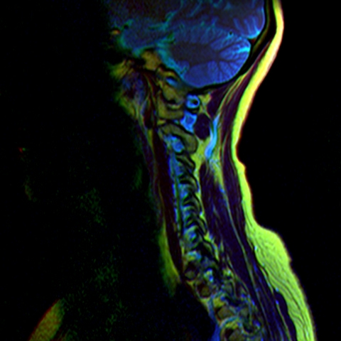Nevit's blog: Cervical spine Color MRI