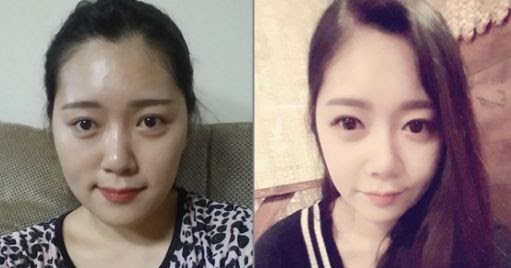 Plastic Surgery in Korea : Latte’s Plastic Surgery Real Review (Two Jaw ...