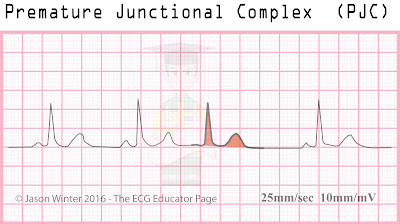 ECG Educator Blog : Junctional Rhythms