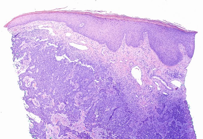 VIRTUAL GRAND ROUNDS IN DERMATOLOGY 2.0: Tumor in Vaccination Site