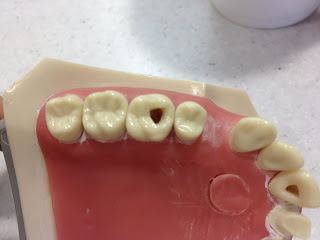 Paul Hung DDS: Dental Advice: How to Pass the NERB Manikin: Endo and Pros