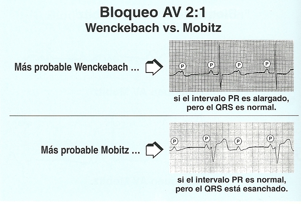 Dr. Rafael Soto - Electrocardiografía - Cardiología clínica: Bloqueos ...