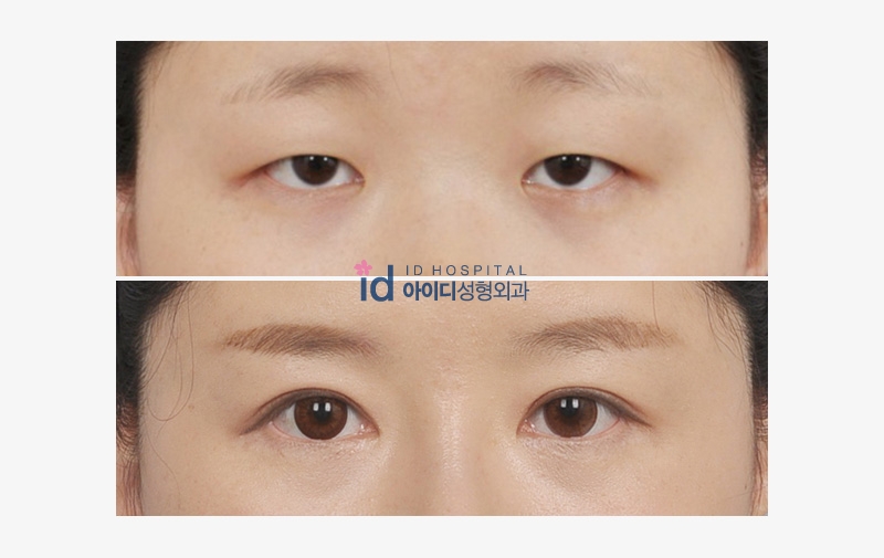 ID Hospital Korea: FAQ Eyelid Surgery! Everything you need to know ...