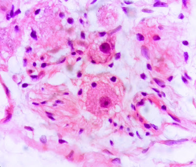 KIMAN - Making pathology simple!!: Ganglion cells - They will find you ...