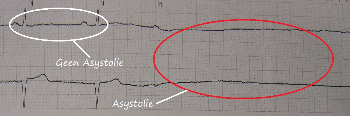 Hoesten bij een hartinfarct of hartstilstand - Acute Zorg Blog