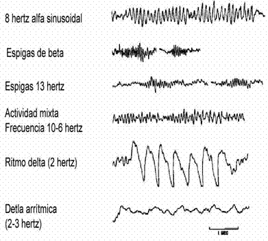 Bioinstrumentacion: Electroencefalograma