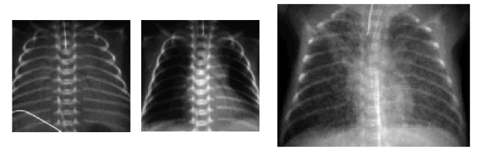 ENFERMEDAD DE MEMBRANA HIALINA & HERNIA DIAFRAGMATICA