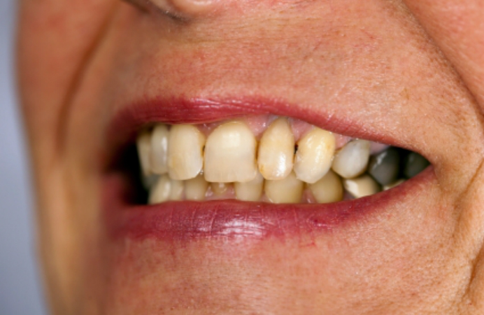 Ai piatra pe dinti? Uite cum iti poti curata dantura chiar la tine ...