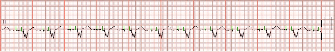 EKG Rhythm Strips 48