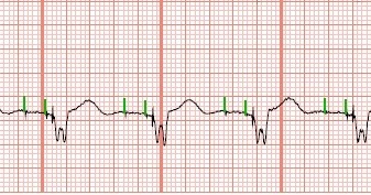 EKG Rhythm Strips 48