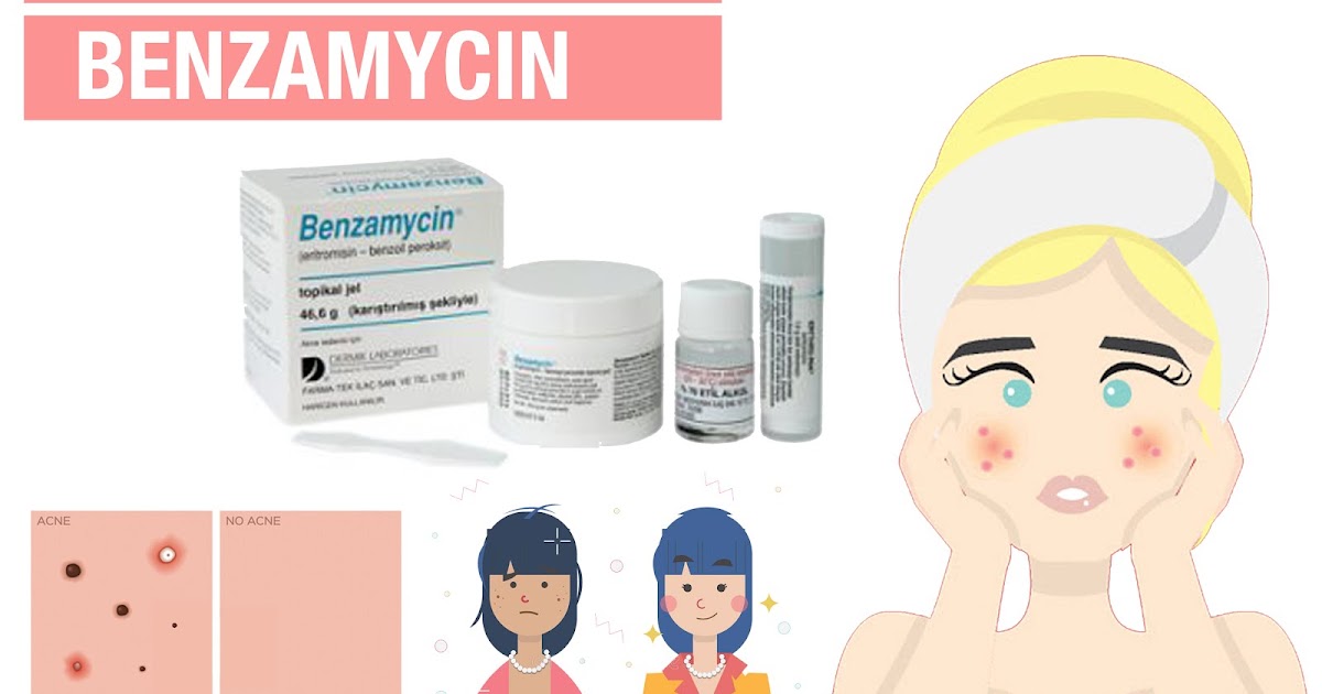 SİVİLCELERİM GEÇTİ! BENZAMYCIN KREM İNCELEMESİ | Bir Fikir Lazım!