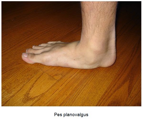 Deformiteti stopala: Pes metatarsus varus (pes adductus).