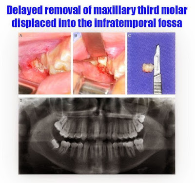 PDF: Delayed removal of maxillary third molar displaced into the ...