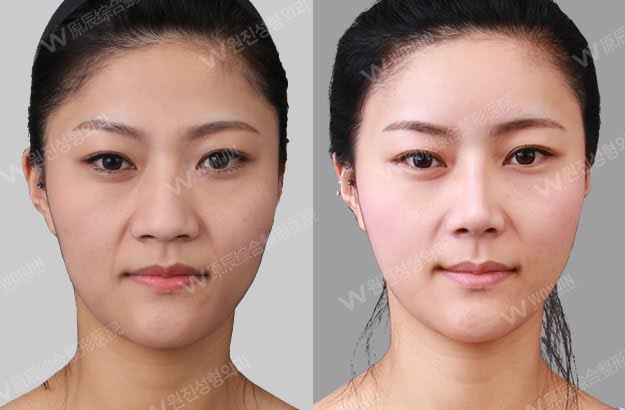 [Before and After Photos] Korean Rhinoplasty - 짱이뻐!