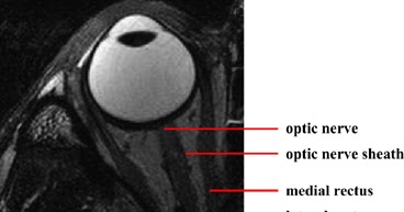 Radiology Anatomy Images : Optic Nerve MRI Anatomy