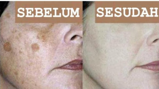 Noda Hitam di Wajah Bikin Gak Percaya Diri, Hilangkan dengan 4 Bahan ...