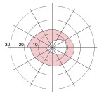 MBBS DOCTORS: Open Angle Glaucoma: POAG