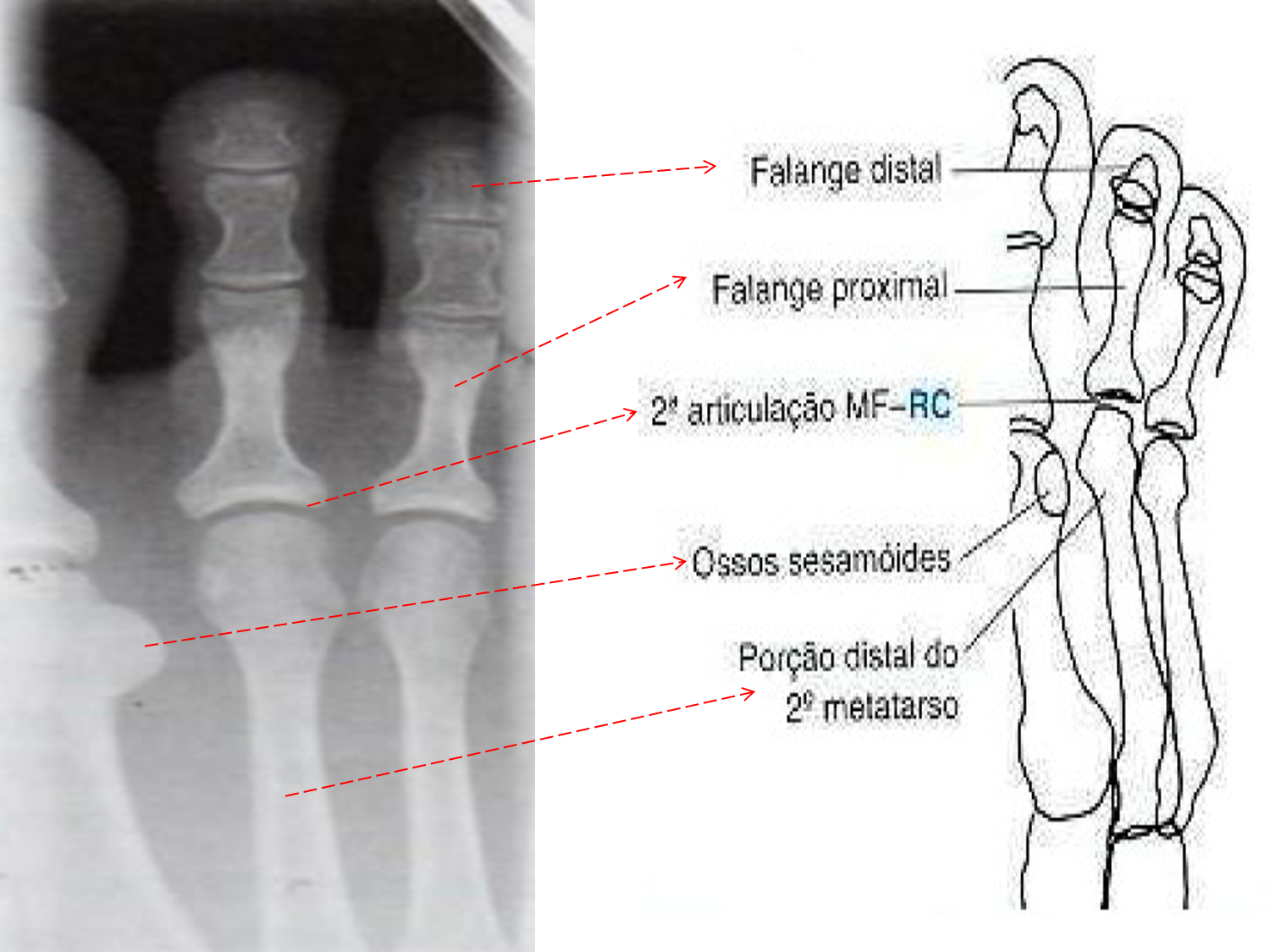 Falange Distal Do Halux - FDPLEARN