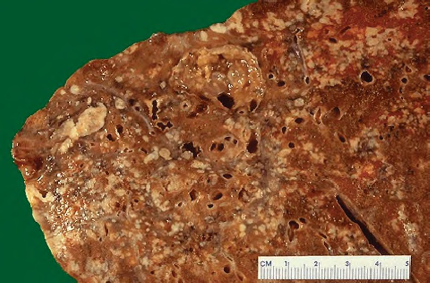 Histopatología: TUBERCULOSIS