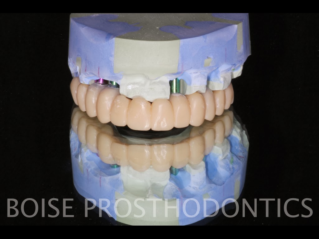 Boise Idaho Prosthodontics: Maxillary Implant Rehab Provisional, Index ...
