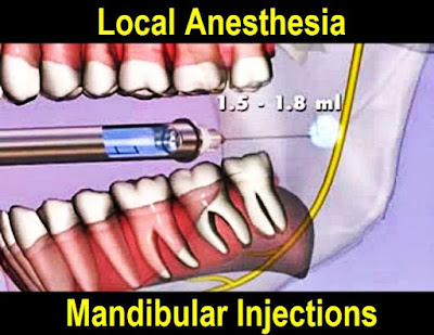 DENTAL ANESTHESIA: Mandibular Injections step by step - Odonto-Tv