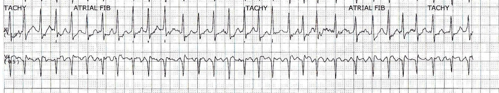 ECG Channel: Atrial Fibrillation