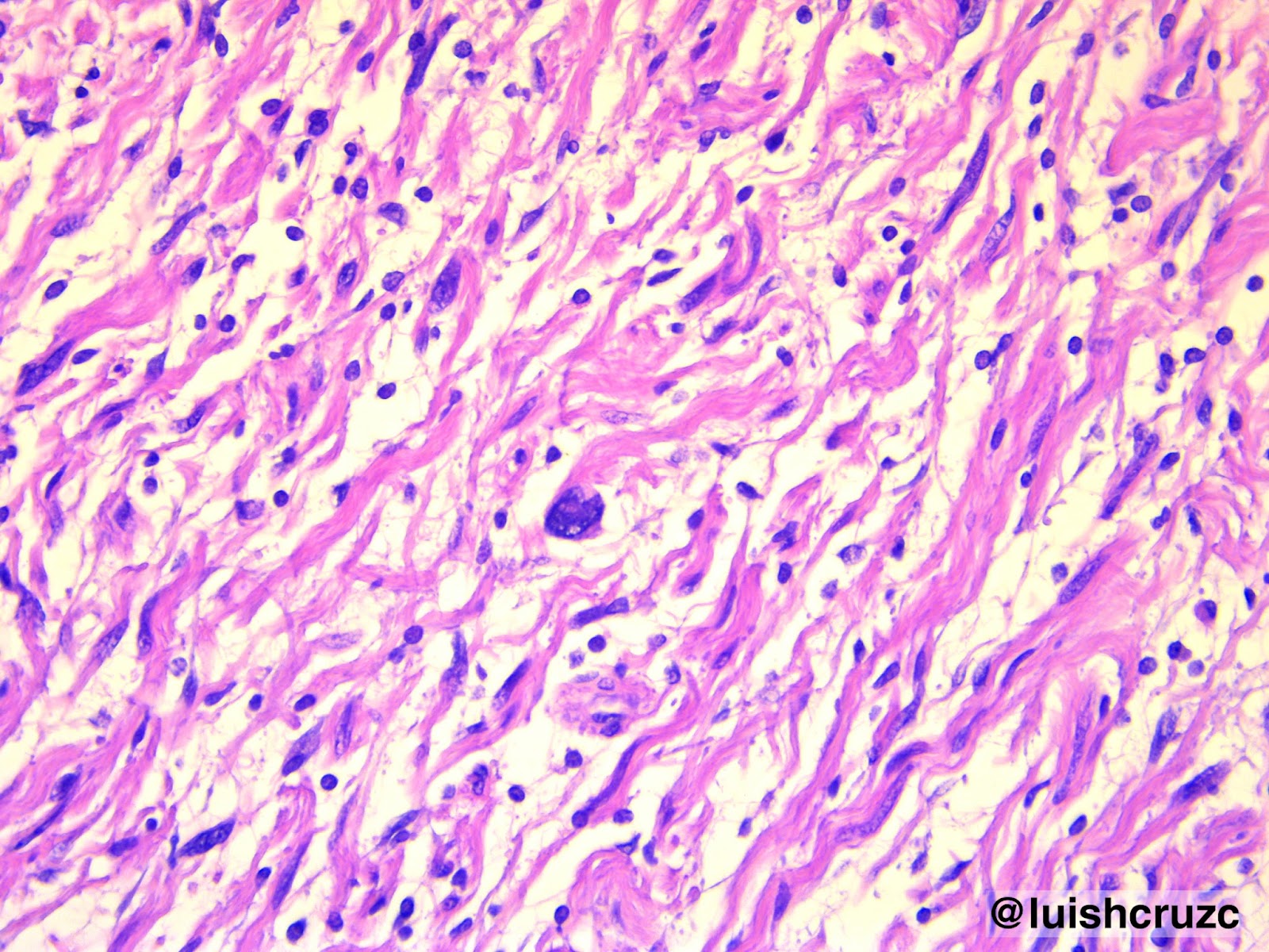 Patología CC: Neurofibroma