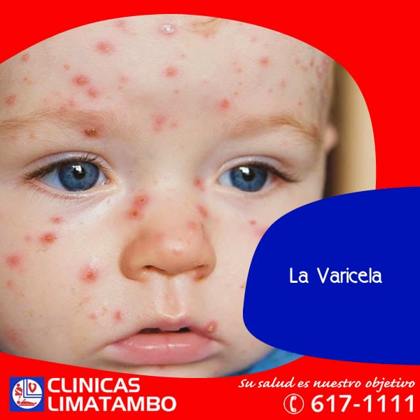 La Varicela ~ Clinica Limatambo