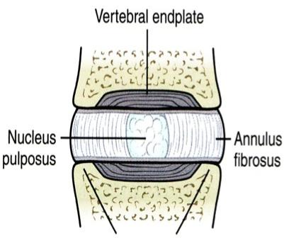 What is Schmorl's node - Definition, Symptoms, Causes, Treatment ...
