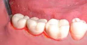 Anestesia y Exodoncia : Incisiones, Colgajos y Suturas