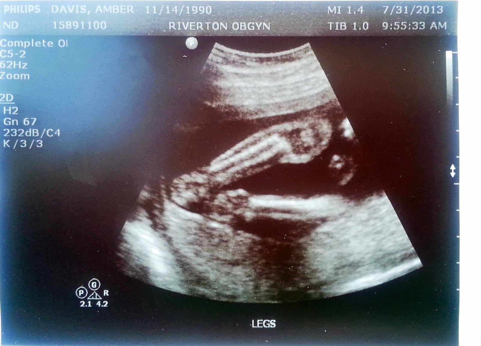 Amber Josh 20 Week Anatomy Scan amber-josh-20-week-anatomy-scan