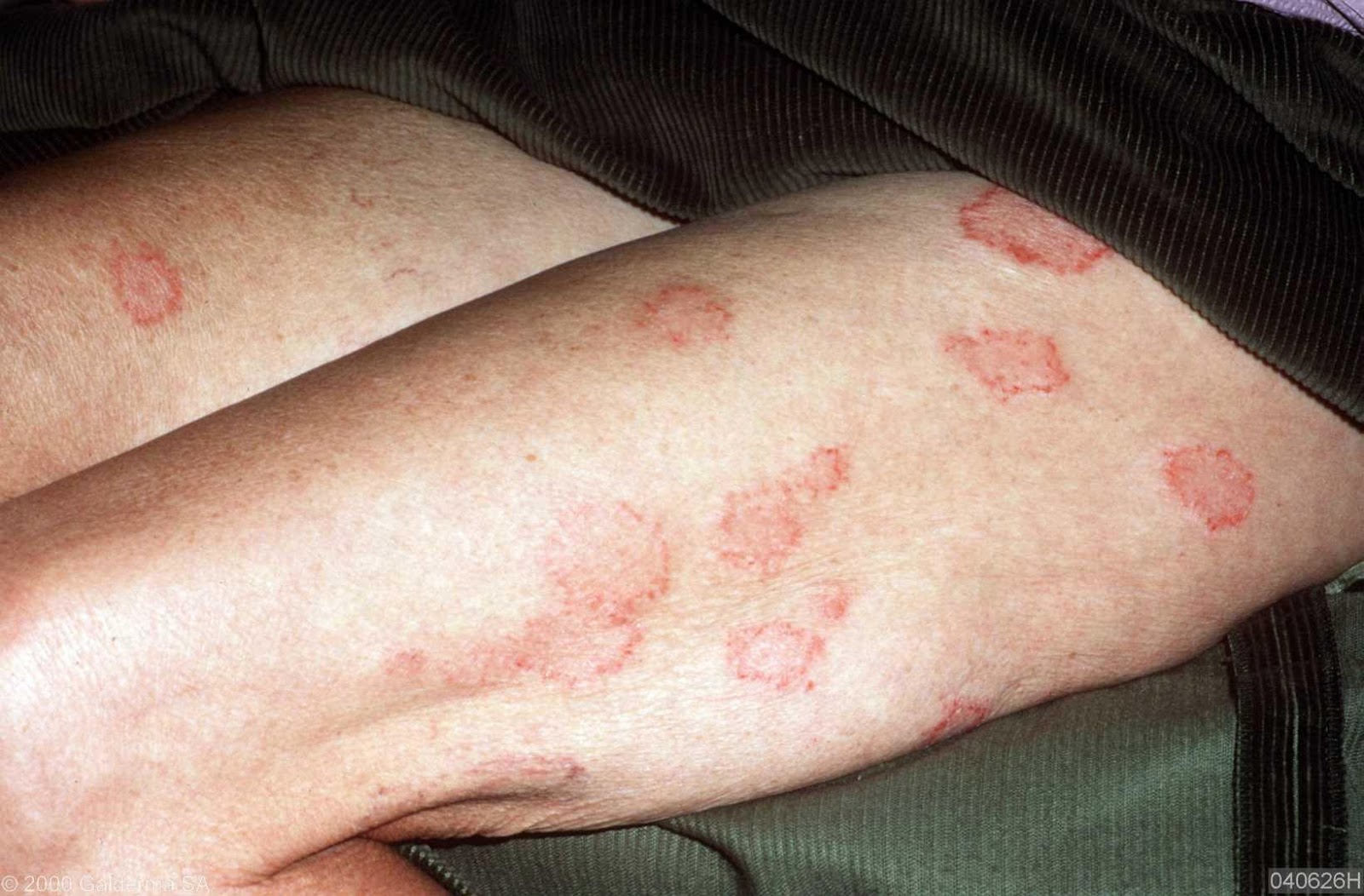 SKIN DISEASE TYPES: Nummular Dermatitis