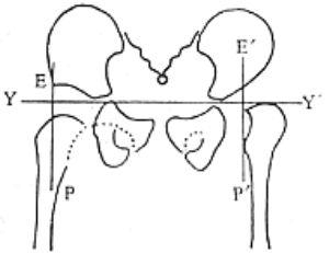 Jay's HealthCare: Congenital hip dislocation