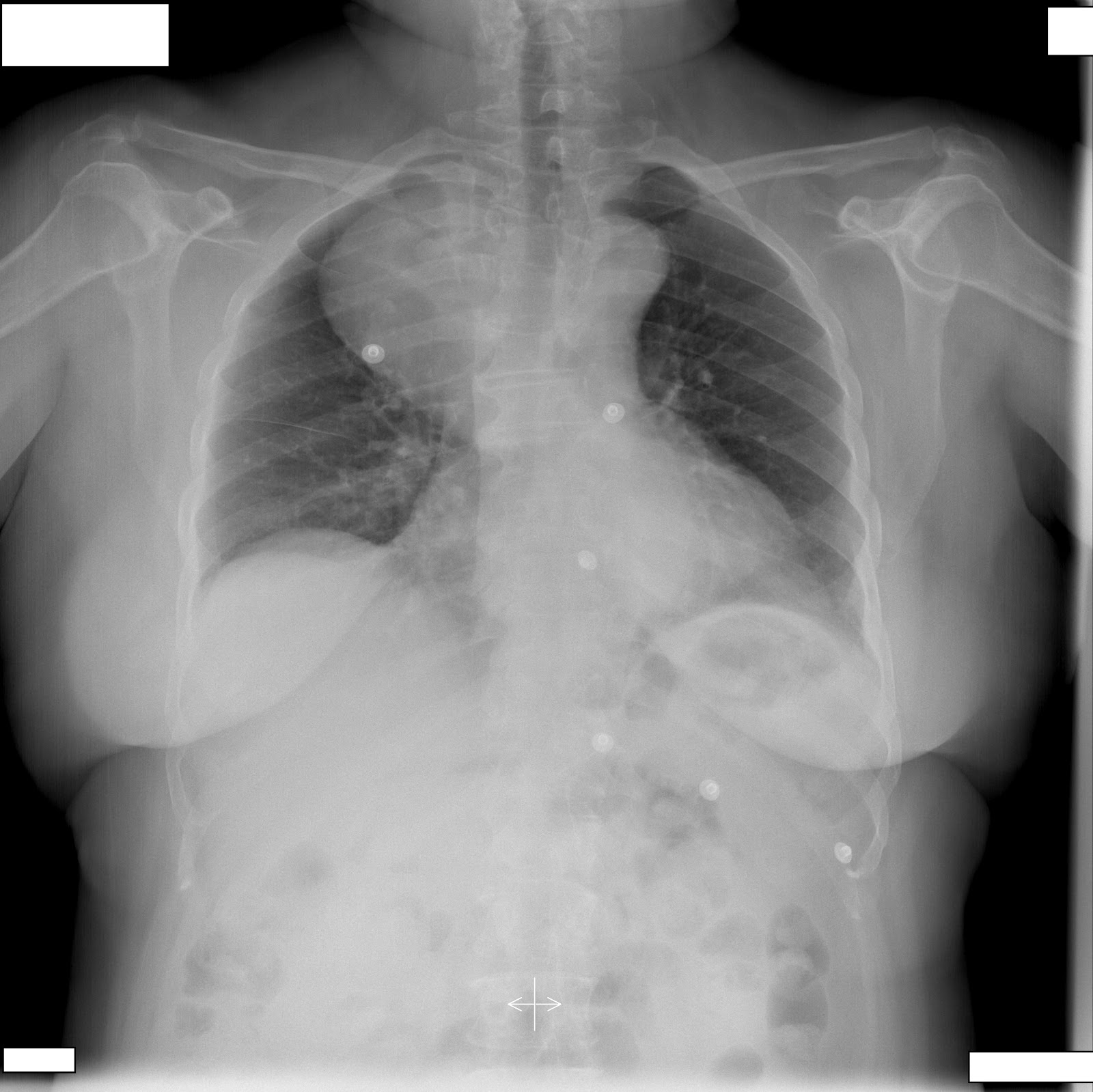 Residentes de familia en Lanzarote.: Bocio intratorácico y, ¡cuidado ...