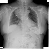 Residentes de familia en Lanzarote.: Bocio intratorácico y, ¡cuidado ...
