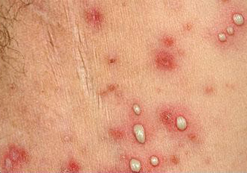 Cream Penghilang Jerawat Ampuh