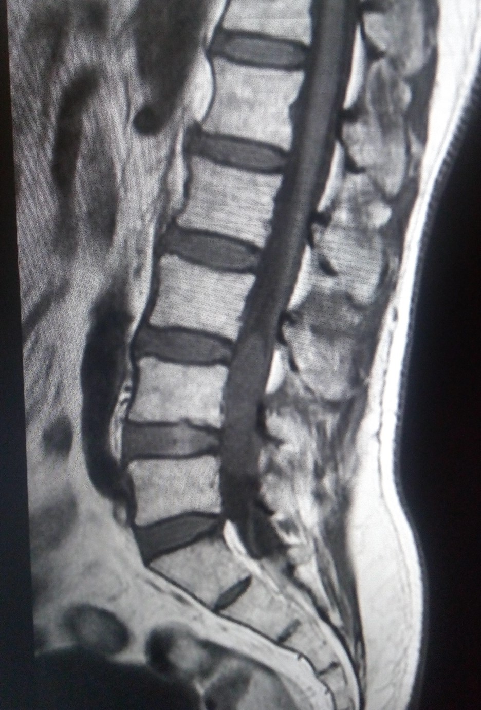 Cauda equina mass: An Approach - Sumer's Radiology Blog