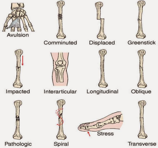 Pengobatan Untuk Memulihkan Penderita Patah Tulang Secara Efektif Tanpa ...