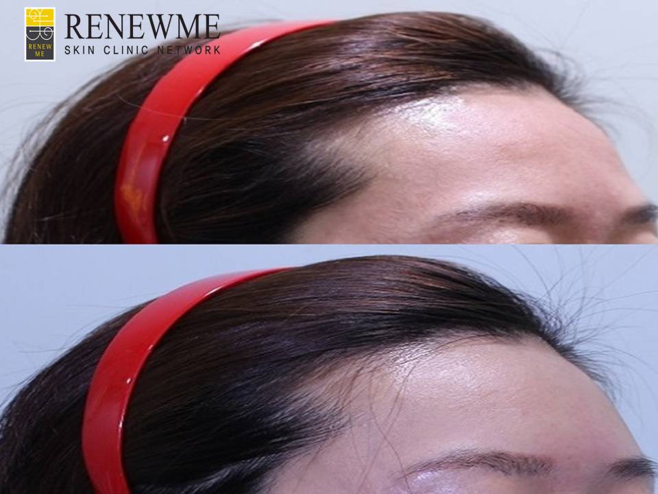 Renewme Skin Clinic: Make beatiful foreheads and Make small face too!
