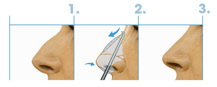 DR. JULIO GAVIDIA - CIRUJANO PLÁSTICO: RINOPLASTIA - CIRUGÍA DE NARIZ ...