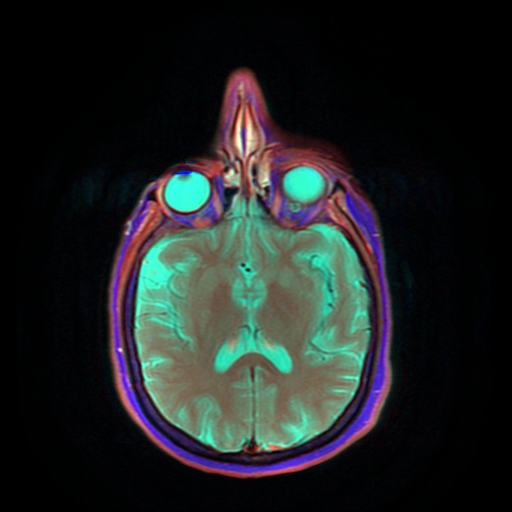 Nevit's blog: Color MRI - Lymphoma of the Neck