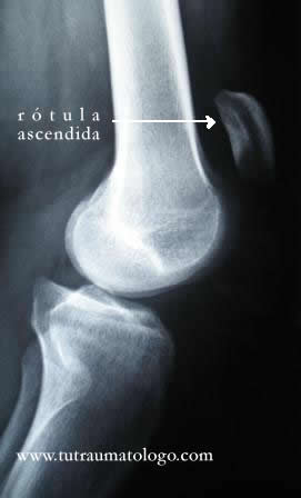 Anatomy for Live: EL TENDÓN ROTULIANO